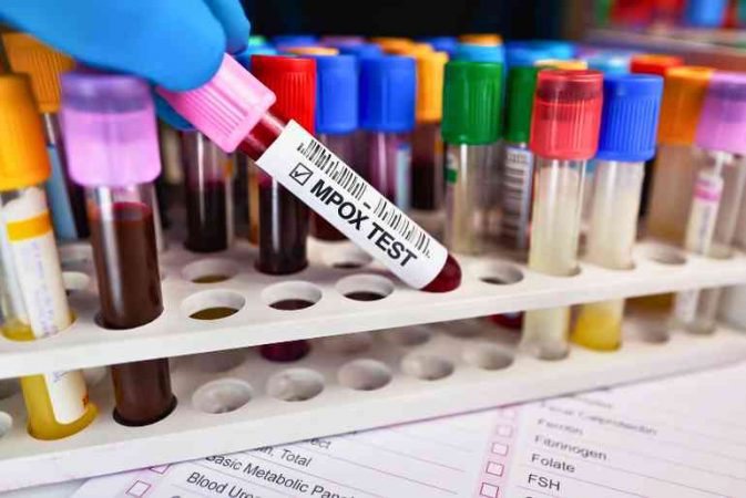 Health Ministry Issues Advisory As India Reports First Mpox Case ...